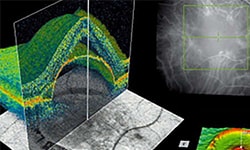 The Versatility of SD-OCT in Patient Screening | Beye